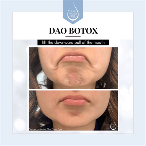 Botox For Dao Lines Blue Water Spa