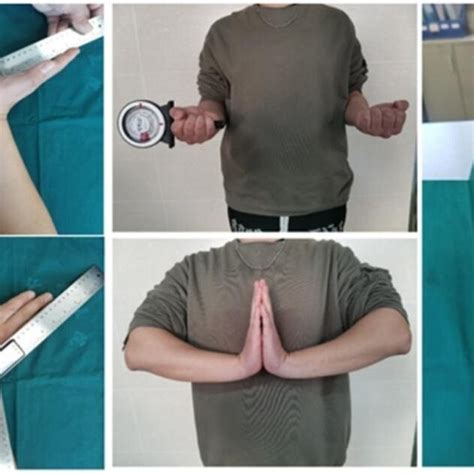 The Ct Images Showed That The Hamate Hook Fracture Had Healed At Three