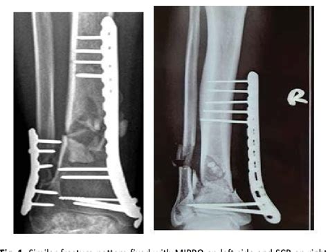 Figure 2 From Lcp As Mippo Vs Lcp As External Fixator Supracutaneous Mode In Open Grade 1