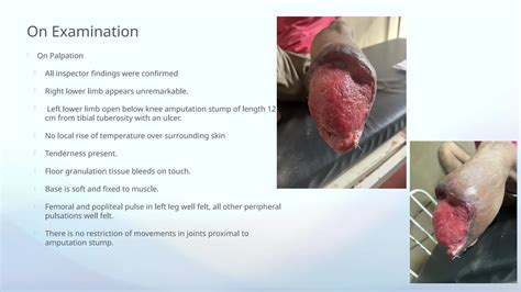A Case Of Below Knee Amputation Gmcpptx