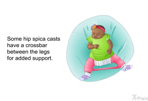 Hip Spica Cast