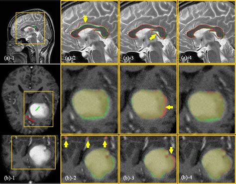 Segmentation Of Homogenous Targets A The Corpus Callosum In A T2 Mr