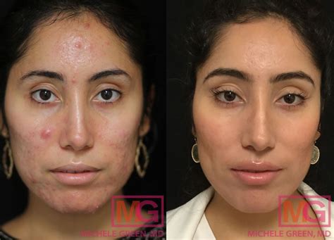 Subcision Acne Scars Nyc Acne Or Chicken Pox Scars