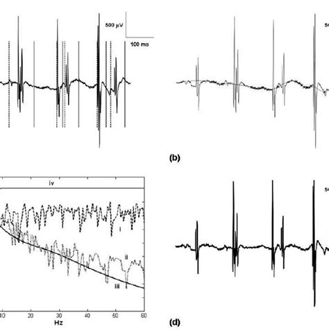 Pdf Influence Of Baseline Fluctuation Cancellation On Automatic