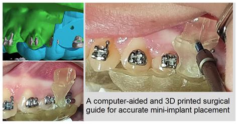 Surgical Guide Template For Implant At Christopher Cummings Blog