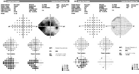Figure 2 From Atypical Form Of Unilateral Optic Neuropathy Caused By Ocular Toxocariasis