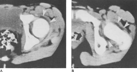 Ct Of A Hip With Effusion Arrows At The Level Of The Head A And