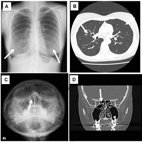 Chest And Facial X Ray And Computed Tomography Ct Findings Of Patient