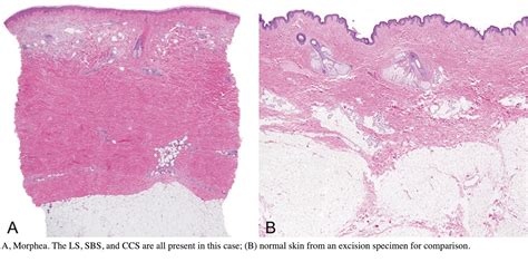 Jerad Gardner Md On Twitter “line Sign” Is A Rapid And Efficient Diagnostic “test” For Morphea