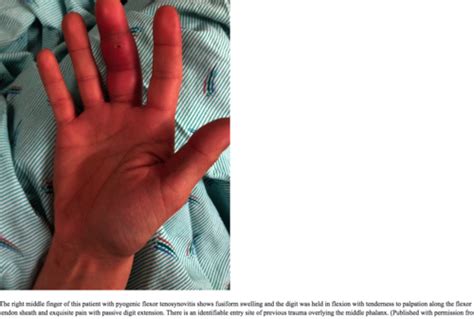 Animal Bites Tetanus Flashcards Quizlet