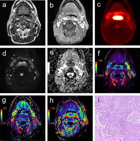 A 63 Year Old Male With Poorly Differentiated Hscc Confirmed By