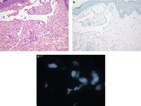 Myc Amplification And Overexpression In Primary Cutaneous Angiosarcoma