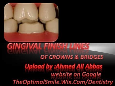 Clasps In Removable Orthodontic Appliance Ppt