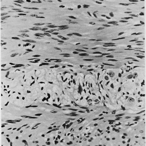 Auerbach S Plexus Ganglion Cells Showing Vacuolation Of The Cytoplasm