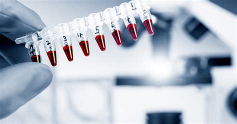 Clinical Trial Is Testing Stem Cells In Scleroderma