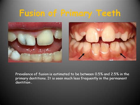 Anomalies In The Development Of The Dentition Ppt Video Online Download
