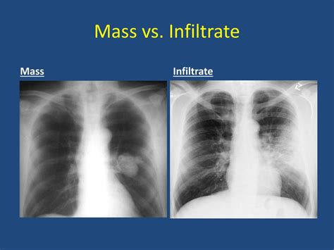 Chest X Ray Consolidation Vs Infiltrate