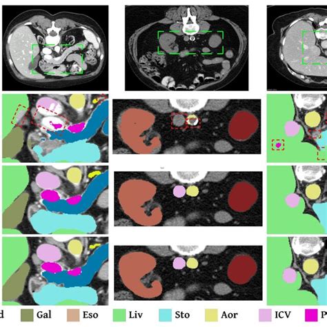 Pdf Unetr Delving Into Efficient And Accurate 3d Medical Image