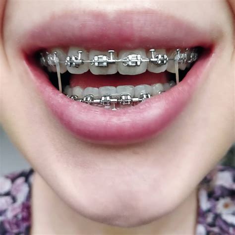 Braces Mouth Piercing At Irma Rushing Blog