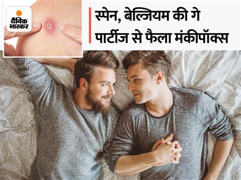 Monkeypox Transmission Monkeypox Virus Disease Likely Spread By Sex In