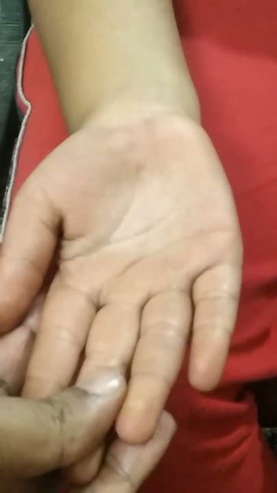 Phalen Test Median Nerve Compression Youtube