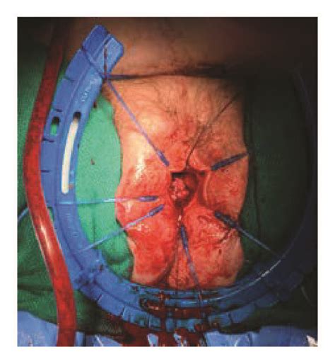 The Bladder Neck Closure Is Seen With Both The Interrupted And