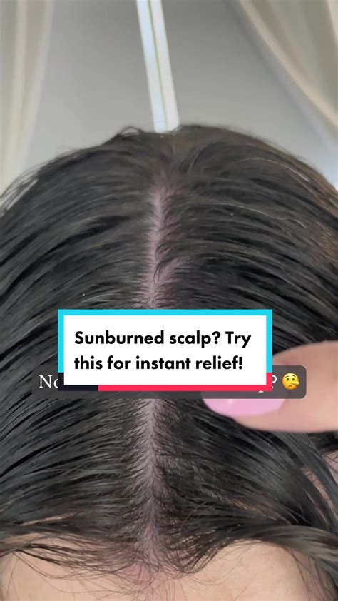 Sunburned Scalp Sun Induced Pustular Dermatosis Of The Scalp A New