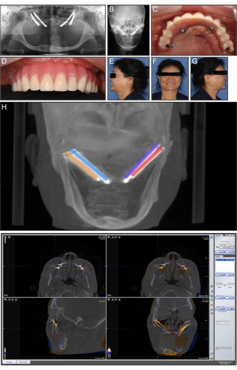 Real Time Dynamic Navigation System For The Precise Quad Zygomatic Implant Placement In A