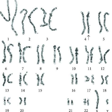 schematic of human karyotype with deletion of chromosome 4q download