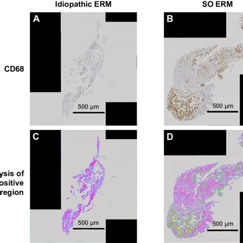 Analysis Of Cd68 Positive Region Notes There Are Few Cd68 Positive