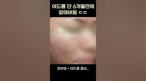 스트레스 극상이었던 여드름 피부의 변화 ㄷㄷ 여드름없애는방법 약초필링 여드름치료 Youtube