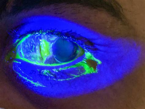Common Eye Emergencies With Differential Diagnosis Cheat Sheet