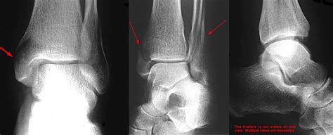 Bimalleolar Fracture