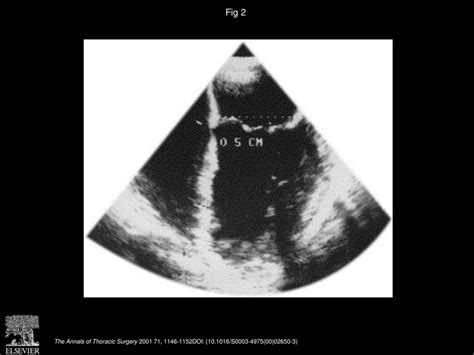Mitral Valve Procedure In Dilated Cardiomyopathy Repair Or Replacement