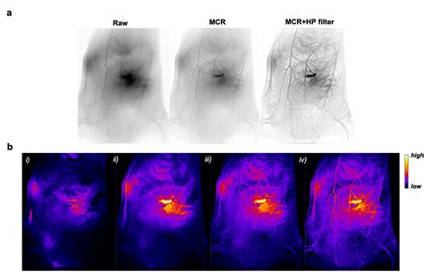 Figure 4 From High Resolution Shortwave Infrared Imaging Of Vascular Disorders Using Gold