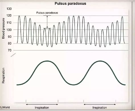 Pulsus Paradoxus Medizzy