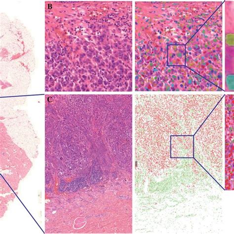 A Digitized Melanoma Tissue Sample B Segmentation Of Every Single