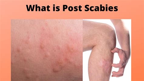 What Is Post Scabies Youtube