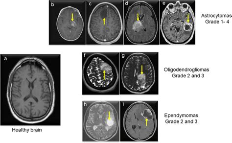 Mr Imaging Of The Different Types Of Glioma Astrocytoma Download Scientific Diagram