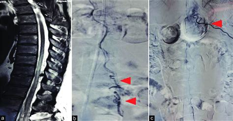 a sagittal t2 sequence showing multiple flow voids b digital download scientific diagram