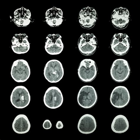 Looking Back At Esoc 2024 New Trials For Tenecteplase