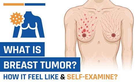 What Does A Breast Tumor Look And Feel Like And How To Self Examine