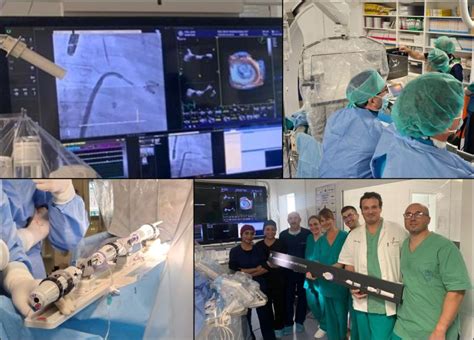 Andrija Matetic On Linkedin First Cases Of M Teer Using The Pascal System At The University Andrija Matetic On Linkedin First Cases Of M Teer Using The Pascal System At The University