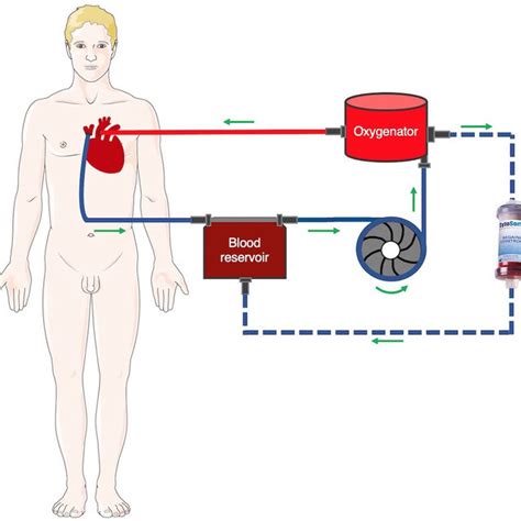 Cytosorb Integration In The Cardiopulmonary Bypass System Download