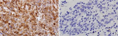 Immunohistochemical Staining Of Aldehyde Dehydrogenase 1 Aldh1 In