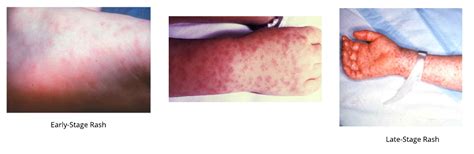 Rocky Mountain Spotted Fever Rash Rocky Mountain Spotted Fever