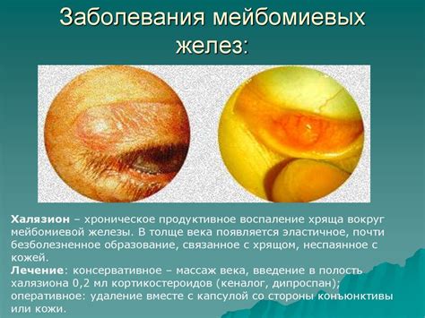Красный глаз Воспалительные заболевание глаза и его придаточного