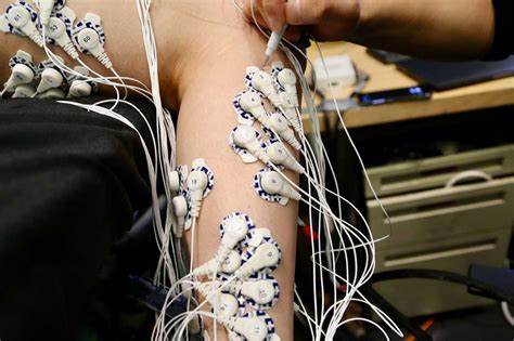 A New Type Of Amputation Surgery May Enable Better Control Of Prosthetic Limbs