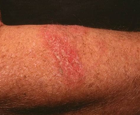 Mycosis Fungoides Pictures Staging Symptoms Treatment And Causes