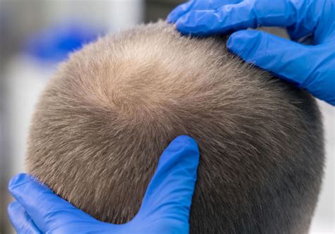 Caida del cabello cuándo preocuparse por caida del pelo